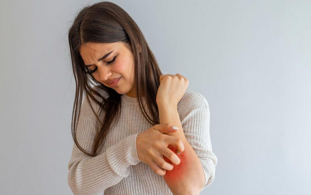 Τριτογενές κάπνισμα και δερματικές παθήσεις - ΚΑΡΦΙΤΣΑ